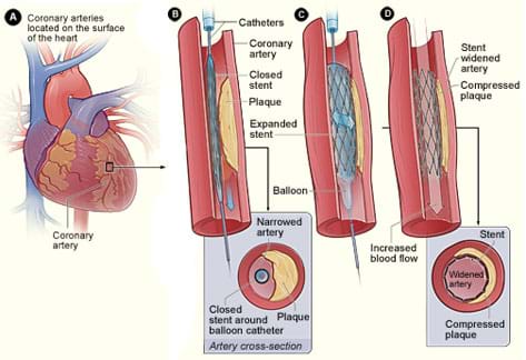Clearing a Path to the Heart - Activity - www.teachengineering.org